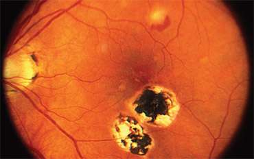 Ocular Histoplasmosis Syndrome Plainfield, Joliet - Windy City Retina